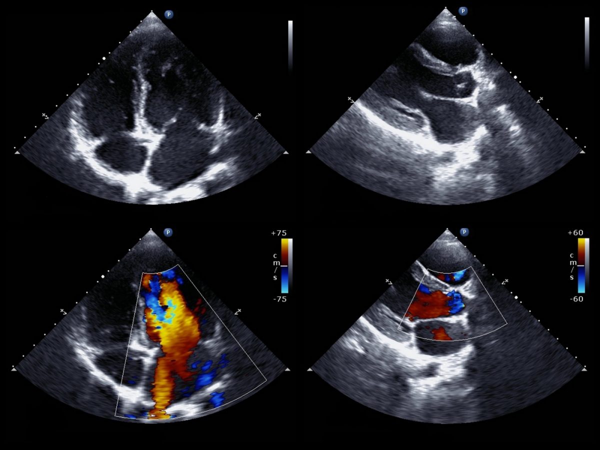 New Tool Assesses Right Ventricular Dysfunction in PH, Congenital Heart ...